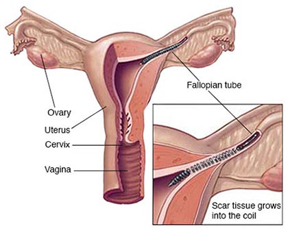 Essure Device